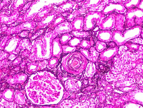 Arterial Thrombosis Middle And Glomerular Ischemic Collapse Lower