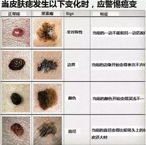 40张图片带你看清各类肿瘤的真面目！全球肿瘤医生网