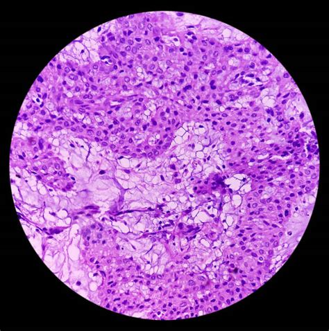 20 Glomerulo Tumore Benigno Immagine Foto Stock Immagini E Fotografie