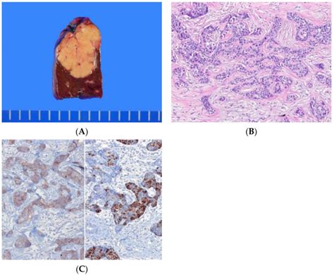 Combined Hepatocellular Cholangiocarcinoma An Update On Pathology And