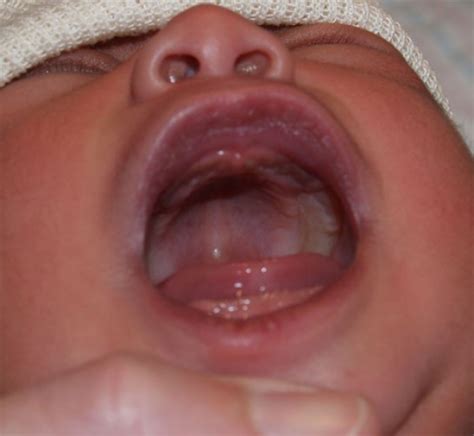 Mouth Newborn Nursery Stanford Medicine