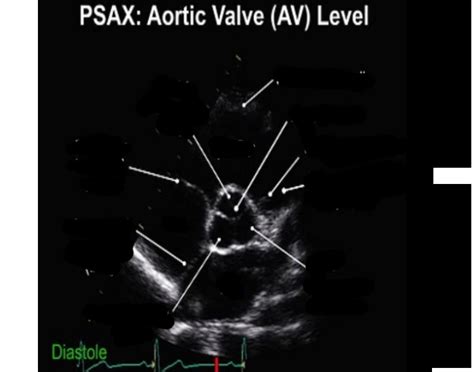 Psax Ao Base View Quiz