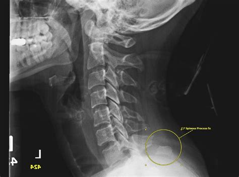Spinous Process Fracture Wikism Sports Medicine Wiki