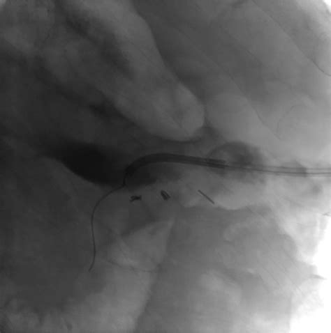 Fluoroscopy Initial Probing With Spyglass Ds Boston Scientific