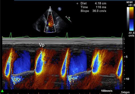 Left Ventricular Diastolic Function By Echo Ase