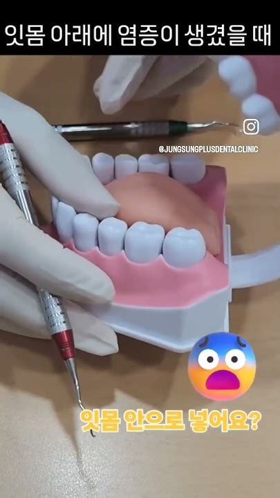 잇몸 아래에 염증이 생겼을 때 Youtube
