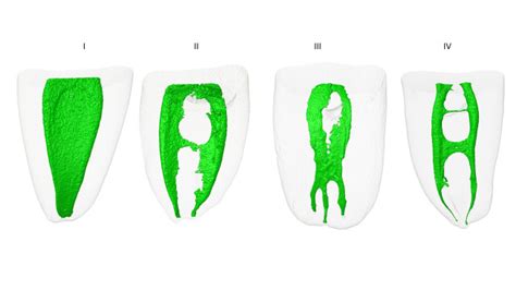 Morphological Assessment Of The Isthmus In Mesial Root Canals Of First