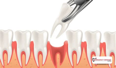 Tooth Extraction Charges Understanding Prices And Care