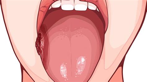 Lip And Oral Cavity Oral Cancer Huntsman Cancer Institute