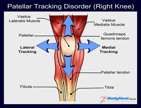 18 Best Patellar Tracking Disorder Images On Pinterest Workouts