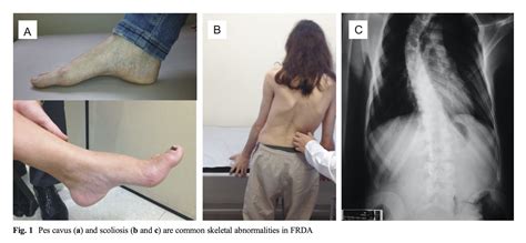 Friedreich Ataxia Dizziness Doctor