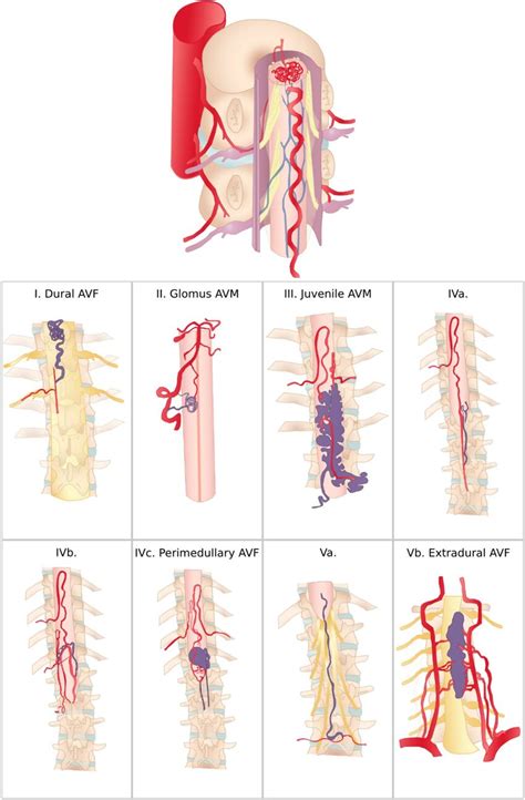Illustration Of The Classification Systems Of Spinal Arteriovenous Fistula Download Scientific