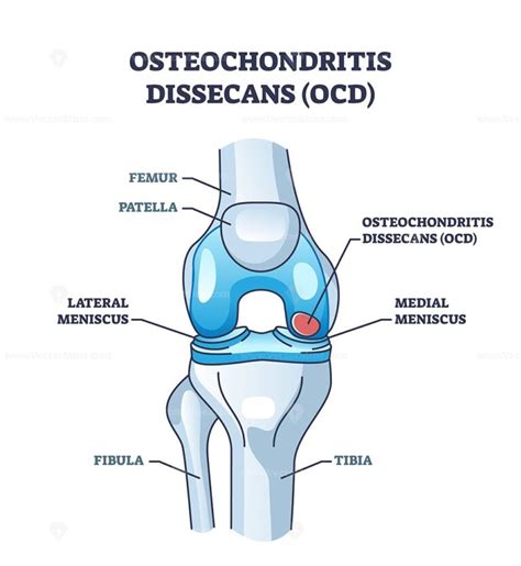 Osteochondritis Dissecans Or Ocd Bone And Cartilage Condition Outline