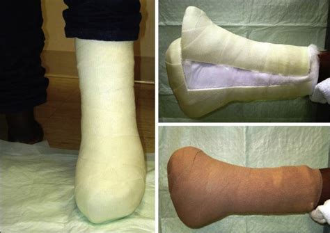 An Approach To Transmetatarsal Amputation To Encourage Immediate