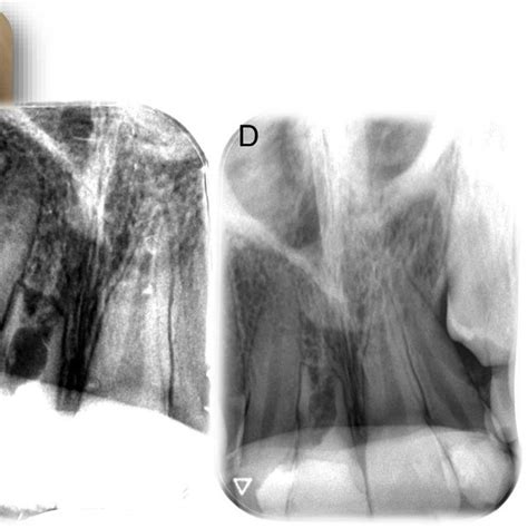 Pdf Regenerative Endodontics A Potential Solution For External Root Resorption Case Series