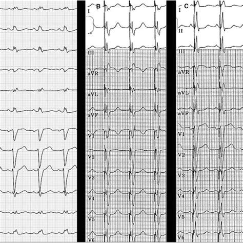 Chest X Ray Tissue Mitral Valve Replacement Carpentier Edwards