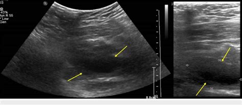 Soft Tissue Ultrasound Scan Collection Of Fluid Within The Left Download Scientific Diagram