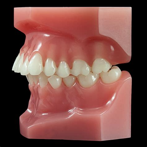 Class Ii Division Malocclusion Ubicaciondepersonas Cdmx Gob Mx