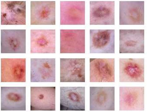 Figure 4 From Automated Multiclass Dermatological Diagnosis Prediction Using Improved Mobile Net