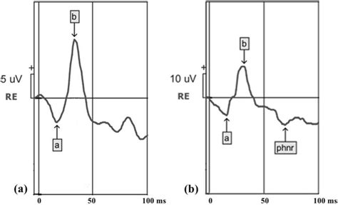 用皮肤电极记录6至12岁儿童的全视野视网膜电图documenta Ophthalmologica X Mol