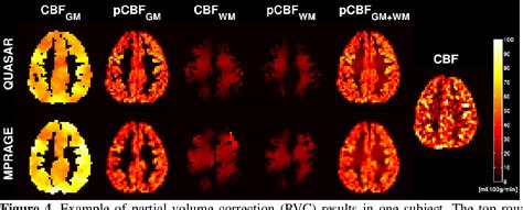 Figure 4 From Correction Of Brain Perfusion Estimates Using The