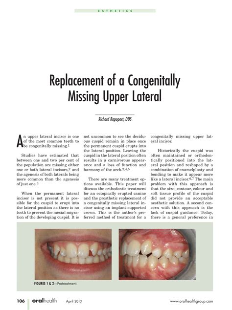Pdf Traumatic Hemisection And Restoration Of A Maxillary First