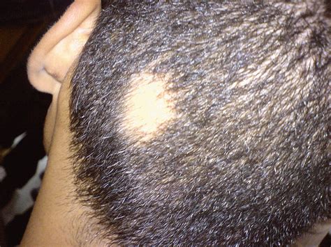 Alopecia Areata Wikipedia