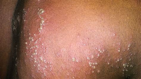 Shingles Overview Symptoms Causes Treatment And More