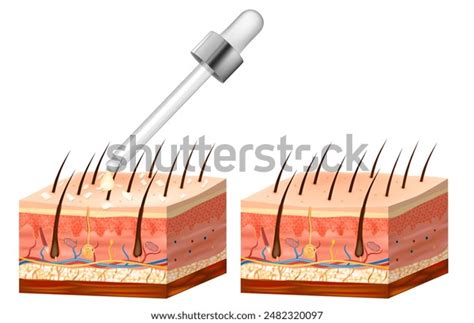 Seborrhoeic Dermatitis Before After Treatment Stock Vector Royalty Free 2482320097 Shutterstock