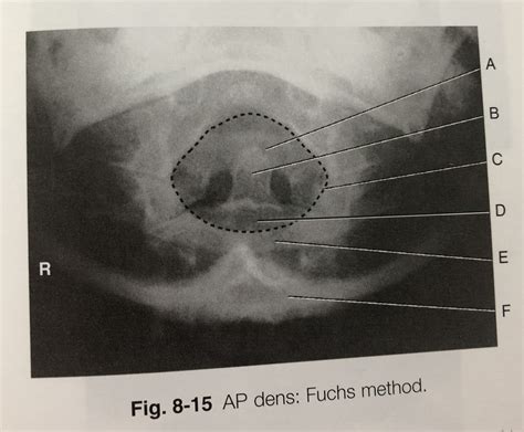 Ap Dens Fuchs Method Diagram Quizlet