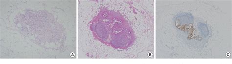 Figure 1 From Lymph Node Micrometastasis In Stage I And Ii Rectal Cancer Semantic Scholar