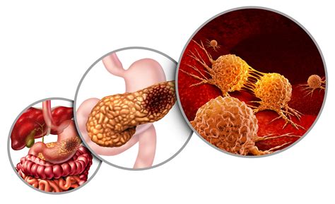 ¿qué Es El Cáncer De Páncreas Conozca Más Sobre Los Tipos Causas