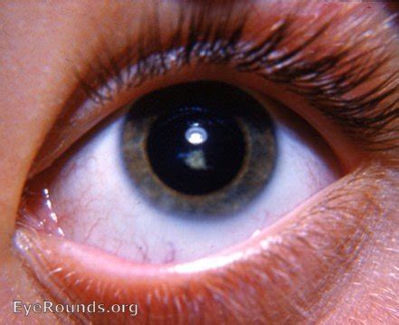 Atlas Entry Anterior Polar Cataract