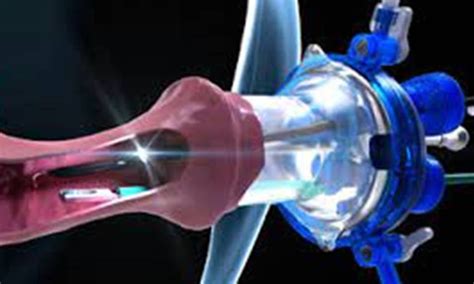 Transanal Minimally Invasive Surgery Tamis