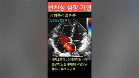 선천성심장질환 심방중격결손증 심장초음파 진단 Youtube