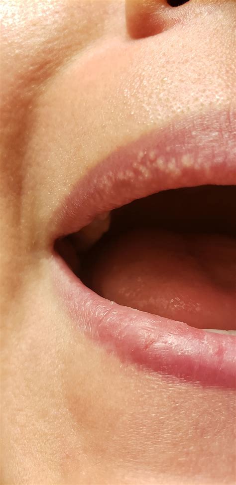 White Bumps On Lips Oral Mucocele Condition Treatments And Pictures