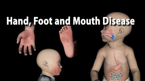 Causes Of Hand Foot Mouth Disease With Cns Complications