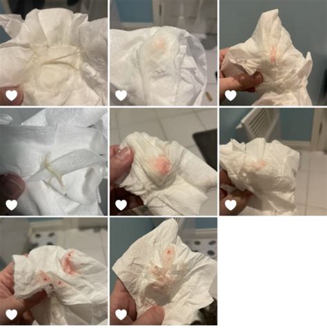 Implantation Bleeding Mumsnet