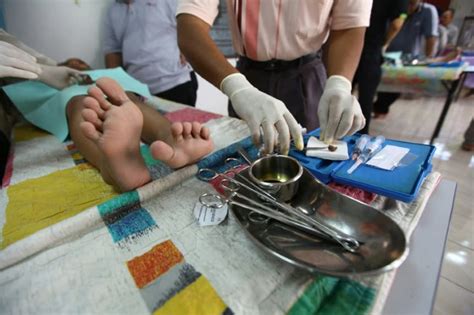 German Cut Circumcision