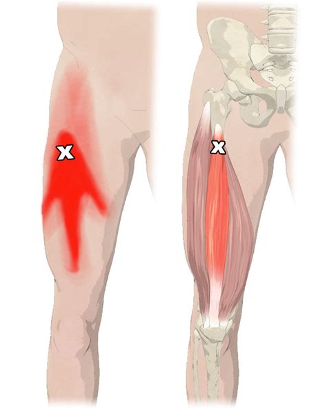 Vastus Intermedius Trigger Point