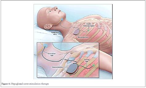 Therapy For Obstructive Sleep Apnea Using Hypoglossal Nerve Stimu
