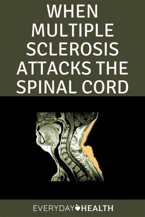When Multiple Sclerosis Attacks The Spinal Cord Artofit