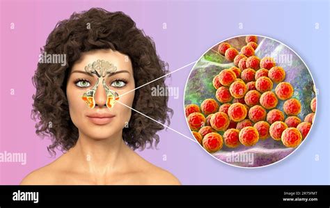 Staphylococcus Aureus Bacteria As A Cause Of Sinusitis Computer