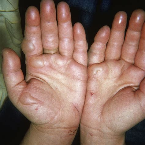 Frostnip Frostbite And Mild Hypothermia Anesthesia Key