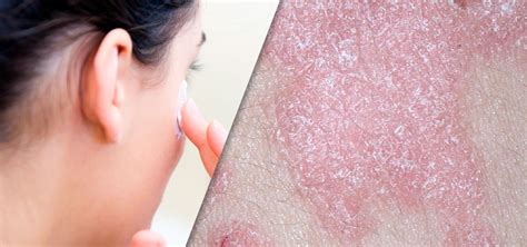 Brief Update On Dermatologic Uses Of Methotrexate