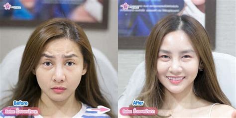 ฉีดโบท็อกหน้าผาก Gangnam Clinic