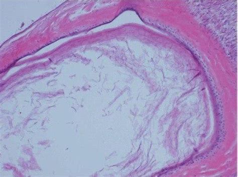 Histopathological Examination Demonstrating Nabothian Cyst And