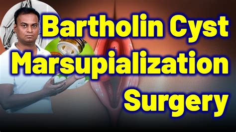 Patients Avoid Marsupialization With Homeopathy For Bartholin Cyst Abscesses Treatment And Cure