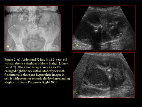 Xanthogranulomatous Pyelonephritis Ultrasound Renal Inflammatory
