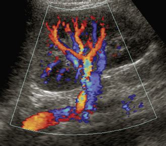 Duplex Ultrasound Of Native Renal Vasculature Clinical Tree